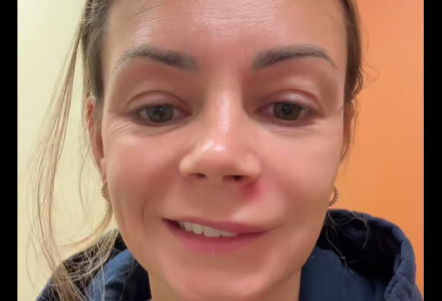 Woman in hospital after popping pimple « Euro Weekly News