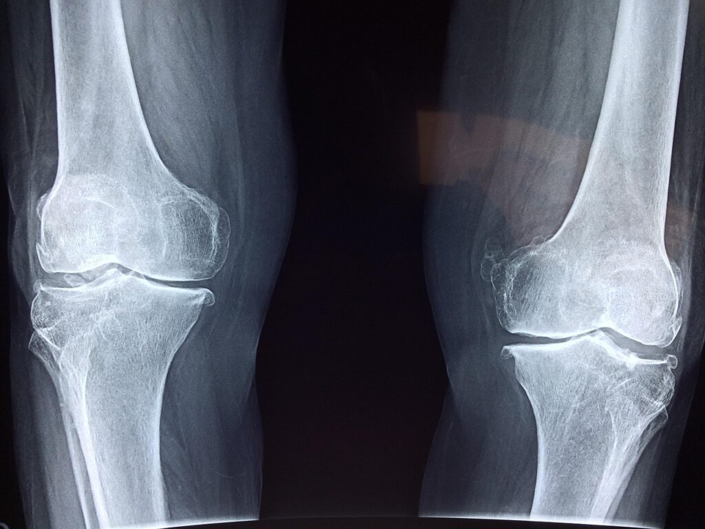 Major arthritis breakthrough « Euro Weekly News