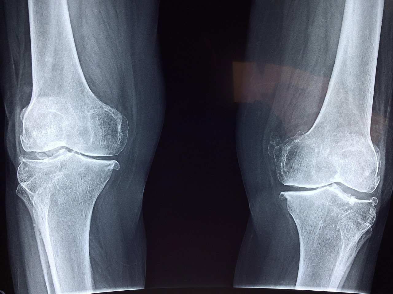 Major arthritis breakthrough « Euro Weekly News